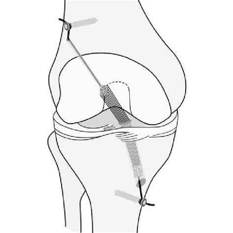 Pdf Long Term Results Of Arthroscopically Assisted Anatomical Single Bundle Anterior Cruciate
