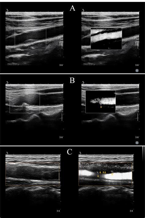 Relationship Between Carotid Intraplaque Neovascularization And Immune Inflammatory Biomarkers