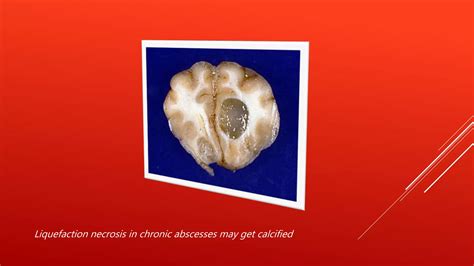 Pathological Calcification Pptx