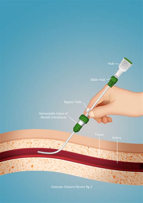 Illustration Project Vascular Closure Device Behance