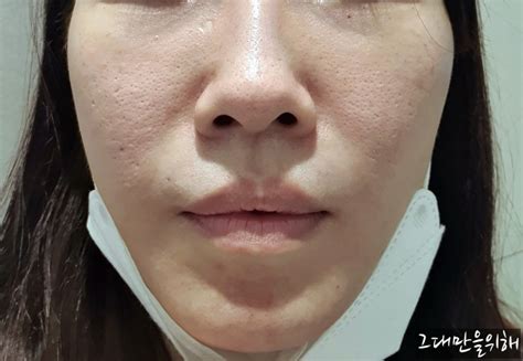 신사피부과 팔자주름 캐번실리프팅 2주차 리얼 후기 네이버 블로그