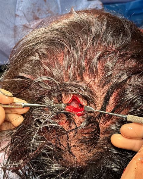 Sagital Scalp Incision For Large 4 Piece Custom Skull Implant Dr Barry Eppley Explore Plastic