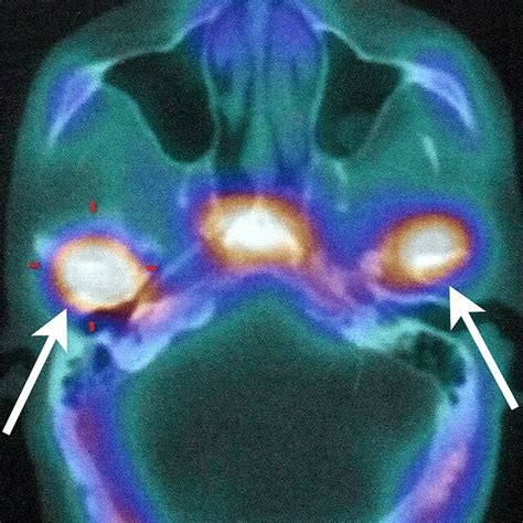Axial Section Of Tc 99m Spect Scan Showing Significantly Increased Download Scientific Diagram