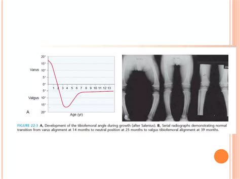 Angular Deformities Around The Knee Seminar Pptx