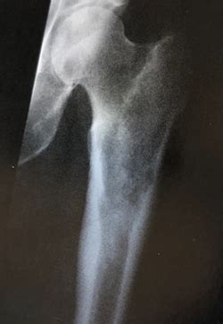 Chondrosarcoma