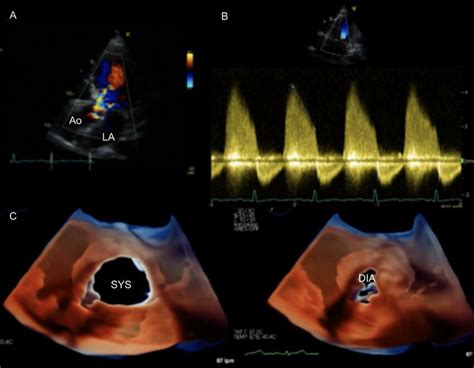 2d Tte With Continuous Doppler And 3d Tee With Color A Apical