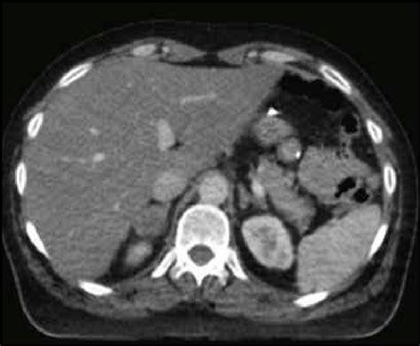 Abdomen Ct Scan Axial Slice Suspicion Of Right Adrenal Secondary Download Scientific Diagram