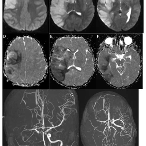 Images A C Diffusion Weighted Imaging Dwi Images D E Adc Maps