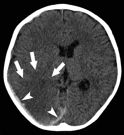 Case 1 Nonenhanced Ct Head Performed At An Outside Facility Showing Download Scientific