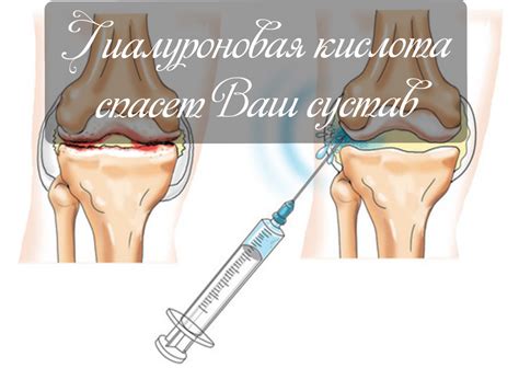 Гиалуроновая кислота спасет Ваш сустав Просто о сложном советы