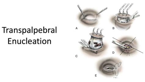 Enucleation Tips Flashcards Quizlet