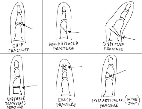 How To Tape A Broken Pinky Toe 9 Steps With Pictures Artofit