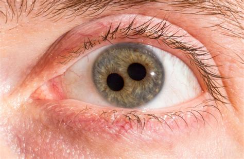 Mengenal Apa Itu Polycoria Dan 2 Jenisnya Ketahui