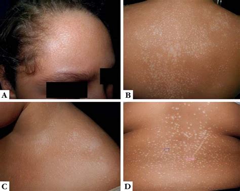 Lichen Sclerosus Et Atrophicus Back