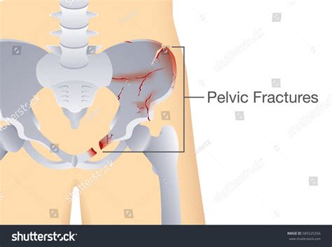 Pelvic Fracture Photos Images And Pictures Shutterstock