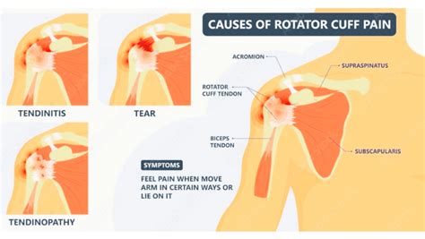 Tips For Treating Rotator Cuff Injuries Surgeon Researcher
