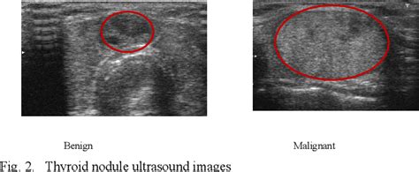 Figure 2 From Cnn And Resnet50 Model Design For Improved Ultrasound Thyroid Nodules Detection