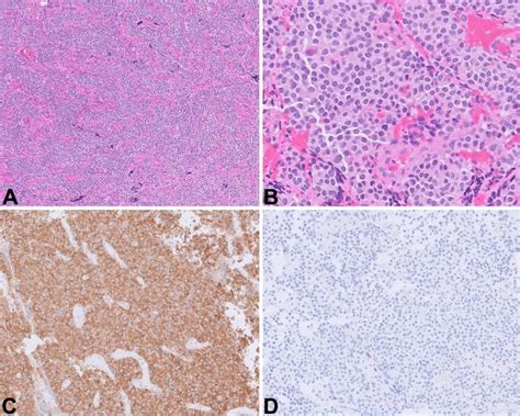 Olfactory Neuroblastoma A Nested Pattern Hande 100x B Hande 400x C Download Scientific