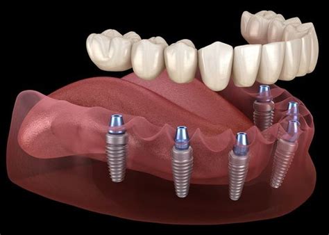 How Safe Is Getting Dental Implants In Turkey