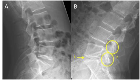 Lumbar Spine Xray Abnormal