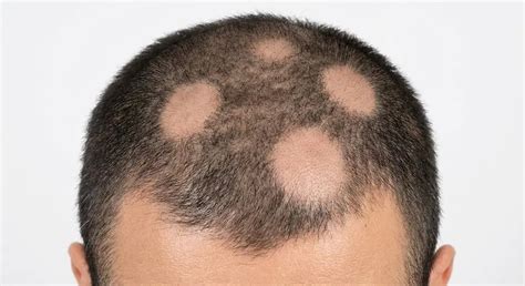 Hair Loss In Men Signs Causes And Treatments Vera Clinic