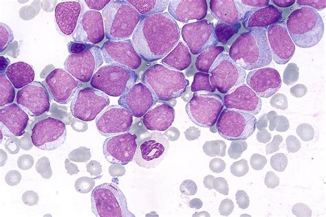 Foto Apa Itu Leukemia Myeloid Akut