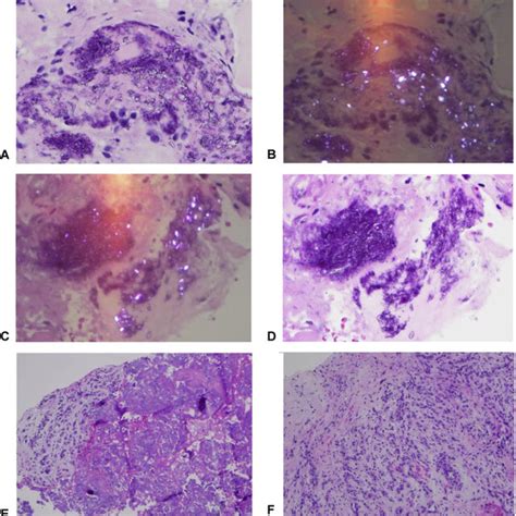 A C The Rhomboid Crystals Which Do Not Stain B D Polarized Light