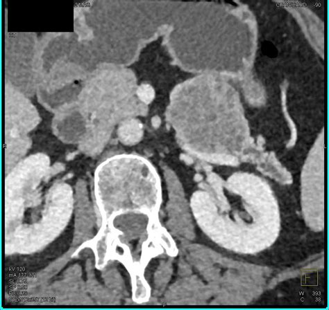Serous Cystadenoma Tail Of Pancreas With Dilated Distal Duct Pancreas