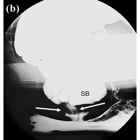 Different Devices That May Be Used To Instill Rectal Contrast Include