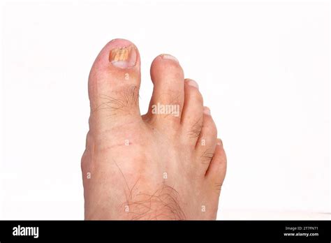 Micose Nail Fungus Infection On Big Toe Fungal Infection On Fingernails Toe With Ringworm