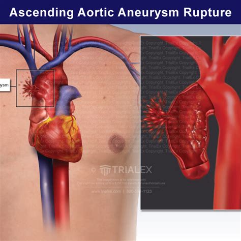 Exposure Of The Aortic Valve And Coronary Ostia Trial Exhibits