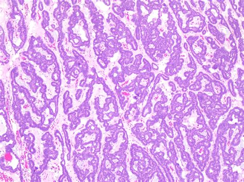 Your Pathology Report For Canalicular Adenoma Mypathologyreport
