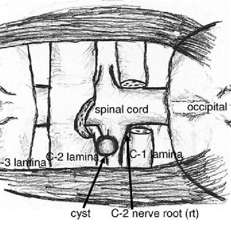 Illustration Of The Surgical Exposure After C 1 And Partial C 2 Download Scientific Diagram