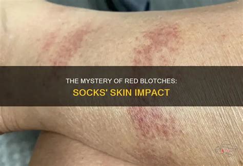The Mystery Of Red Blotches Socks Skin Impact Shunvogue