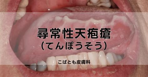尋常性天疱瘡（てんぽうそう）｜こばとも皮膚科｜栄駅（名古屋市栄区）徒歩2分