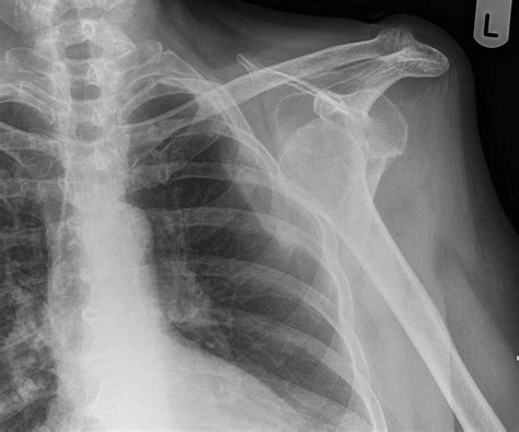 Shoulder Dislocation X Ray Positioning At Matthew Greig Blog