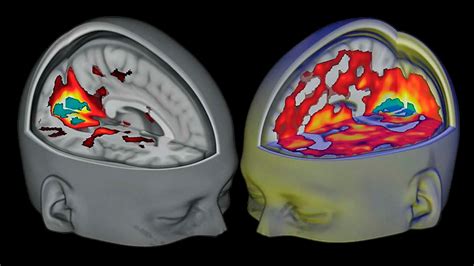 Descubren Los Efectos Del Lsd En El Cerebro Gracias Al Modelado