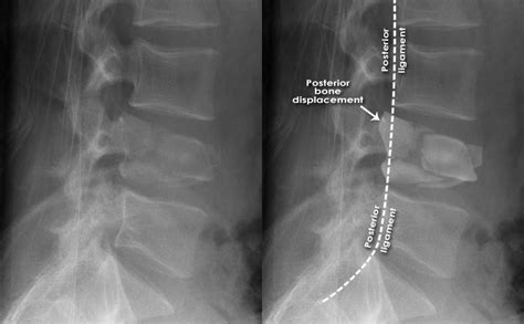 Fractured Spine X Ray Thoracic Spine Fracture Dislocation Posterior