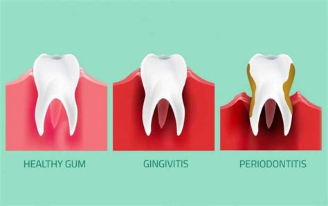 Periodontitis Vs Gingivitis A Comprehensive Comparison