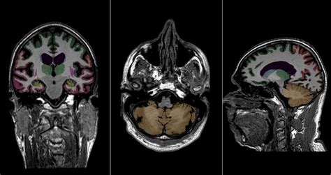 Neuro Suite Deephealth