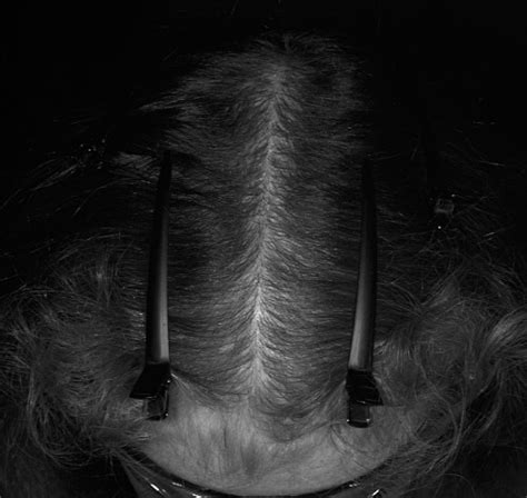 Midline Global Scalp Photograph At Baseline Showing Sinclair Clinical Download Scientific