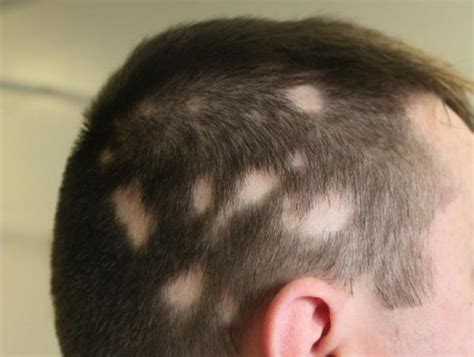 Alopecia Areata Patchy Hair Loss Causes Symptoms Treatment — Hair Med