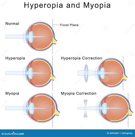 Myopia And Hyperopia Stock Vector Illustration Of Hyperopia 40924891