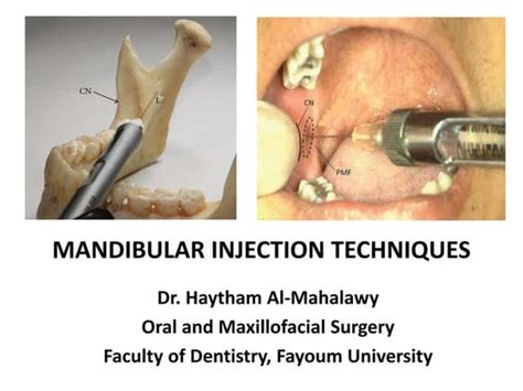 Mandibular Anesthesia Inferior Alveolar Nerve Block Ppt