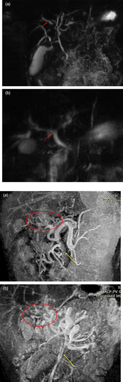 Outcome Of Portosystemic Shunt Surgery On Pre‐existing Cholangiopathy