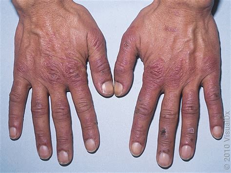 What Are Chilblains Causes Symptoms Treatment And More Goodrx