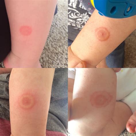 How To Treat A Tick Bite Tick Bite Tick Bites Pictures Tick Bite Symptoms