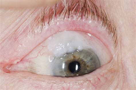Eye Bleb After Eye Surgery Stock Image C016 8227 Science Photo