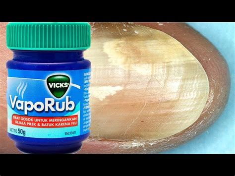 Vicks Vapor Rub Toe Nail