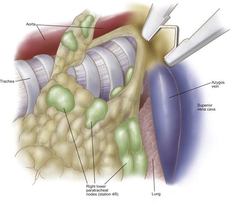 Transcervical Extended Mediastinal Lymphadenectomy Thoracic Surgery